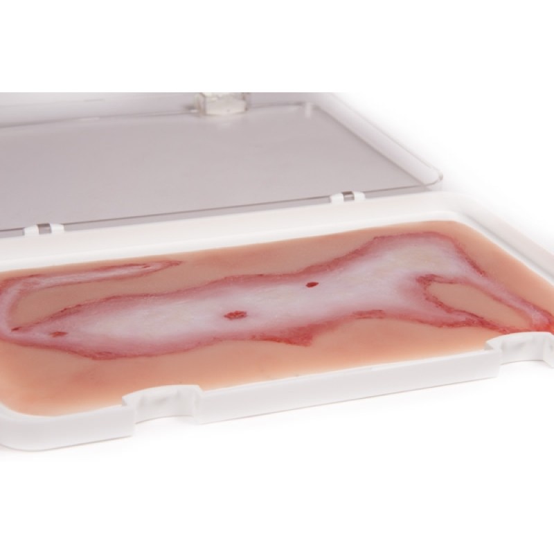 Erler-Zimmer Large Scalding-Burn Moulage - LabWorld.co.uk